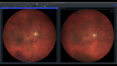 ZEISS AMD Solutions - Retina Today