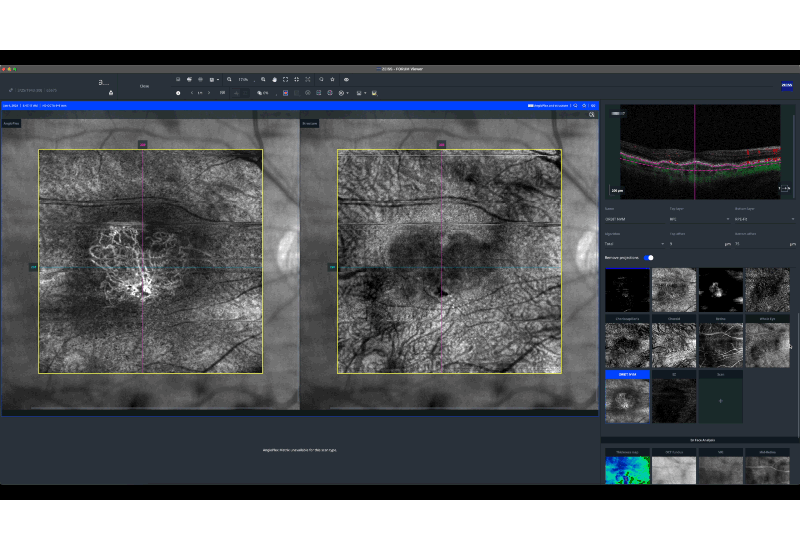 ZEISS AMD Solutions - Retina Today