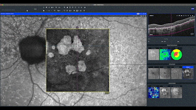 ZEISS AMD Solutions - Retina Today