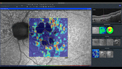 ZEISS AMD Solutions - Retina Today
