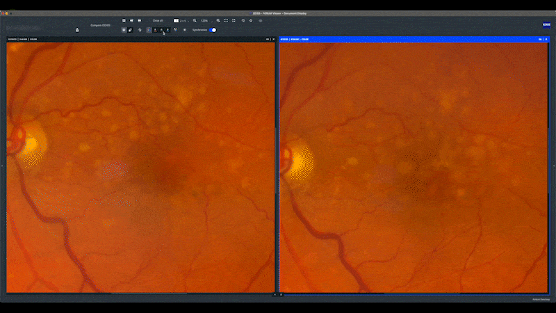 ZEISS AMD Solutions - Retina Today