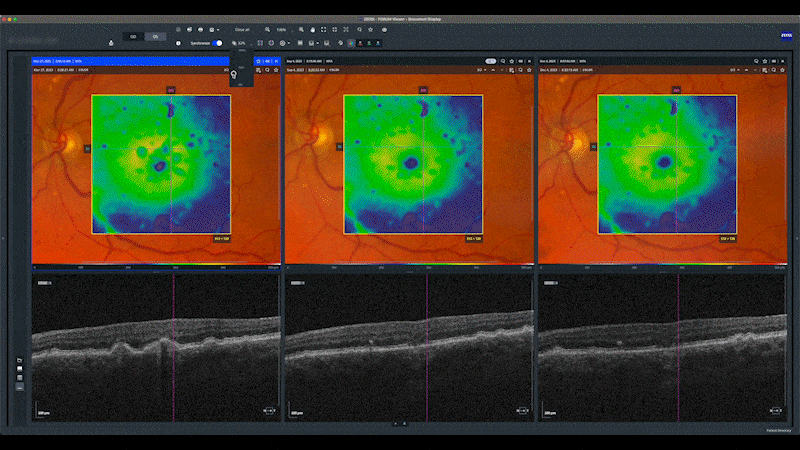 ZEISS AMD Solutions - Retina Today