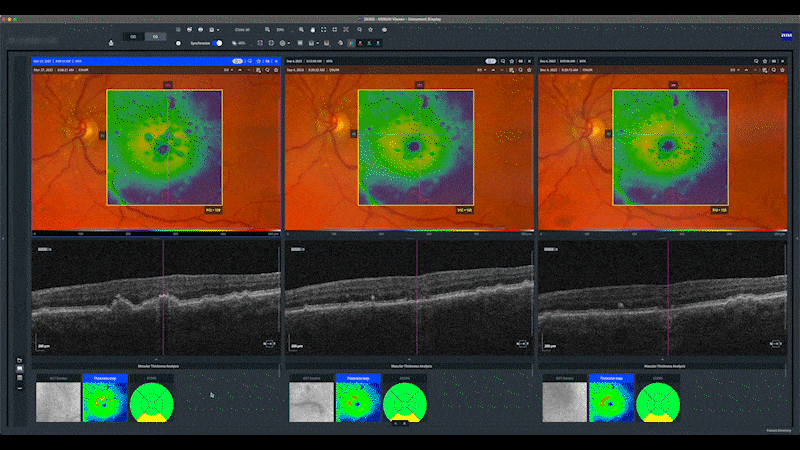 ZEISS AMD Solutions - Retina Today