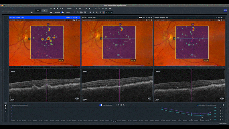 ZEISS AMD Solutions - Retina Today