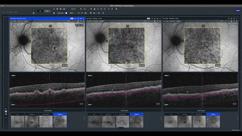 ZEISS AMD Solutions - Retina Today