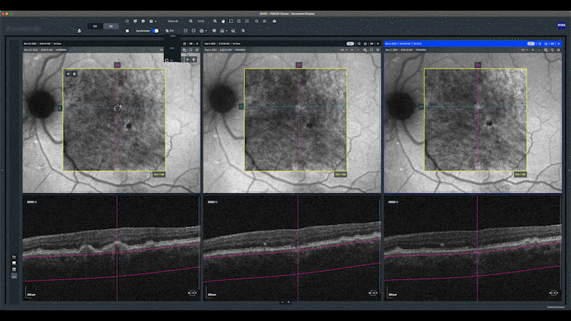ZEISS AMD Solutions - Retina Today
