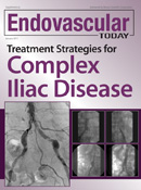 Express LD Vascular Stent for the Treatment of Iliac Artery Lesions ...