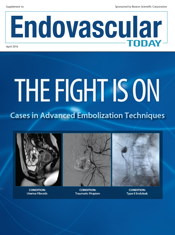 Coiling a Type II Endoleak With a 2-RO, 155-cm Direxion™ Microcatheter ...